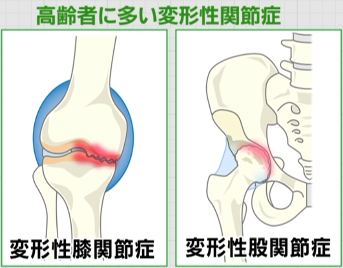 SODANE - 膝や股関節が痛い！放っておくと大変なことに！？『変形性関節症』の原因と対策は？